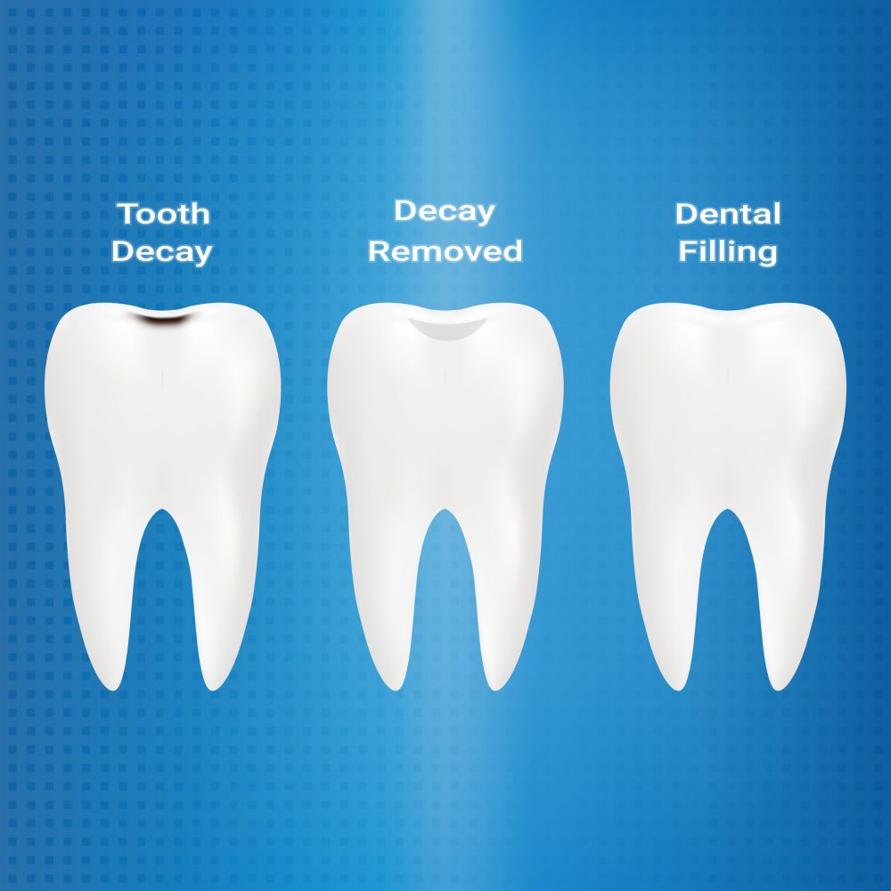 Tulsa Tooth-Colored Fillings - Magnolia Family Dental Care | Tulsa ... Tulsa Tooth-Colored Fillings - Magnolia Family Dental Care | Tulsa ...