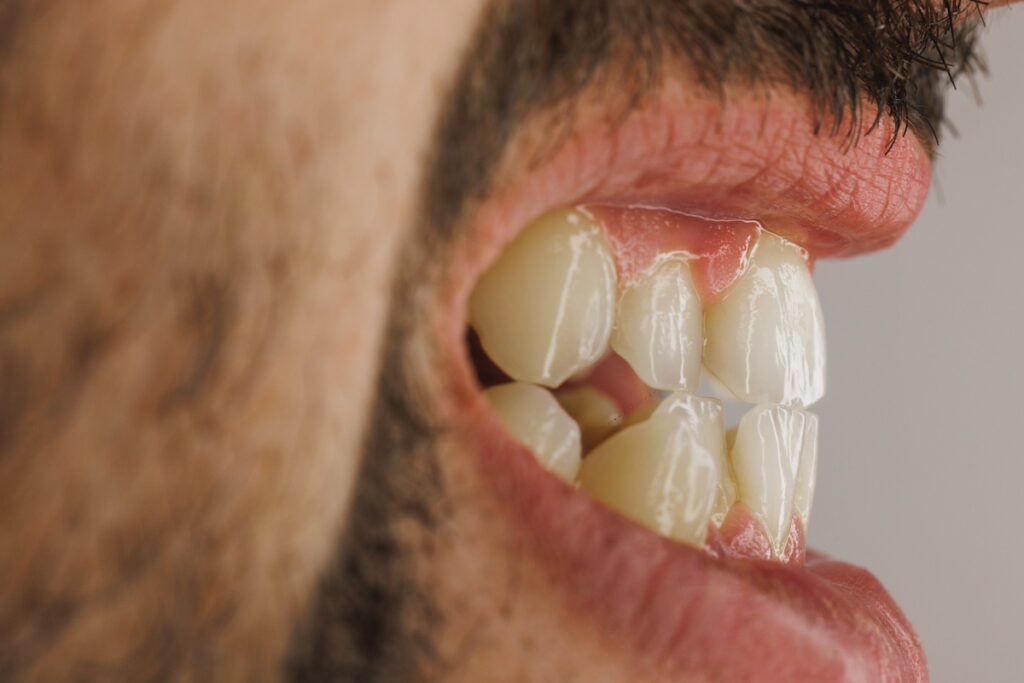Quick Guide: Treat Swollen Gums at Home - Magnolia Family Dental Care ...